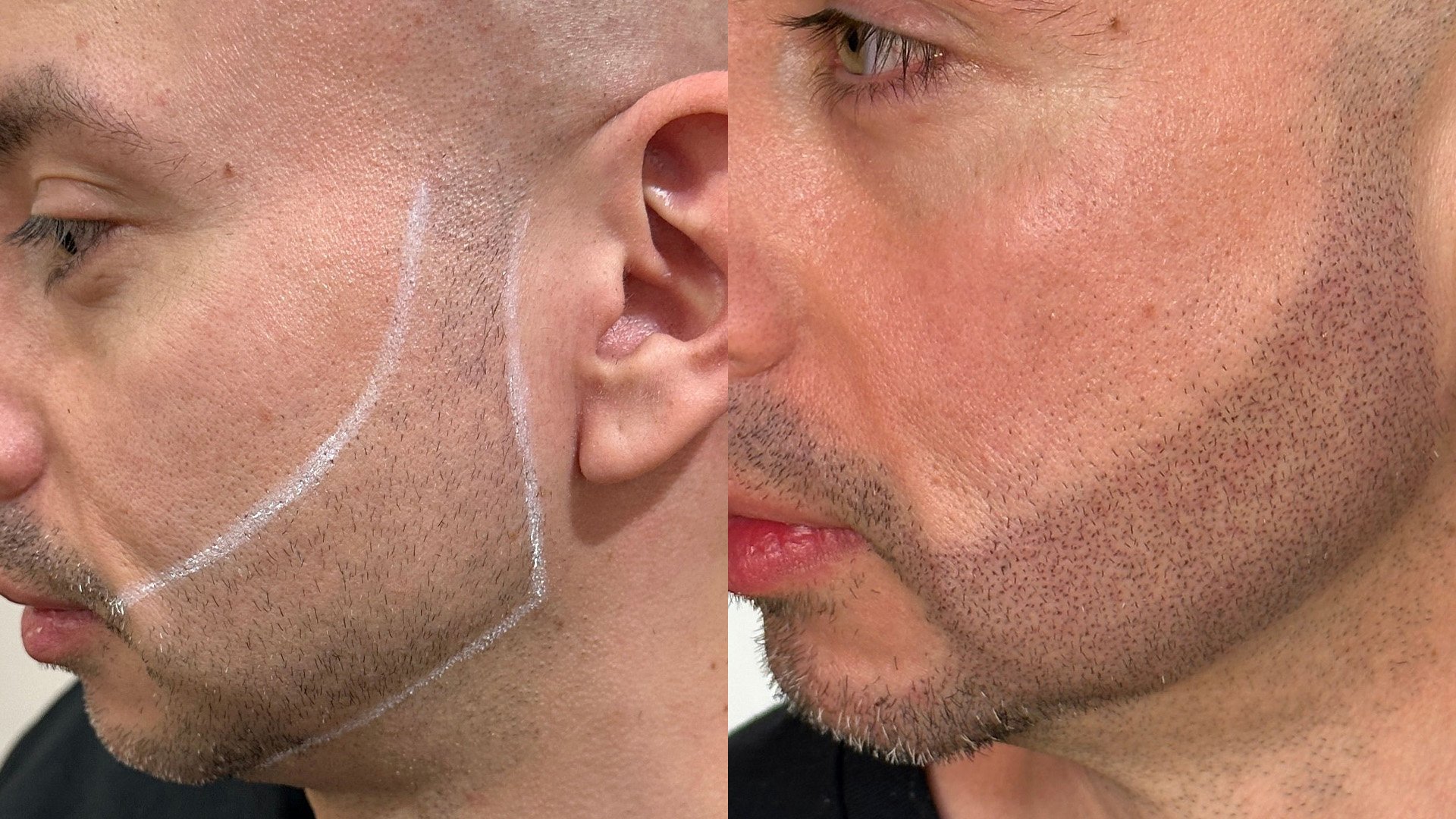 Beard Enhancement - Gerow Scalp Micro